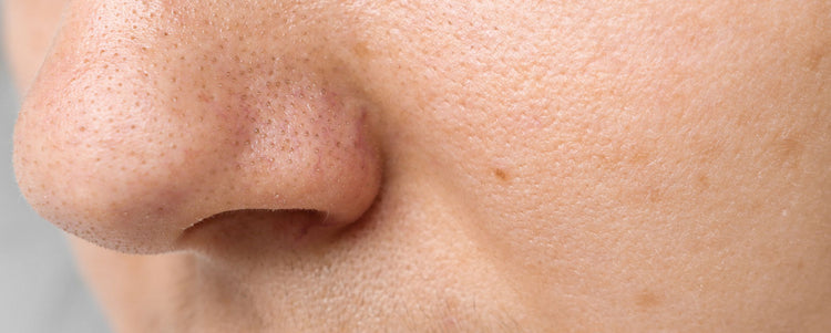 Clogged Pores-Comedogenic and Non-Comedogenic Oils for Skin – Biossential